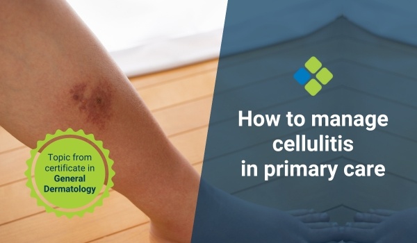 Cellulitis Treatment Cellulitis: Causes, Risk Factors, Symptoms,
